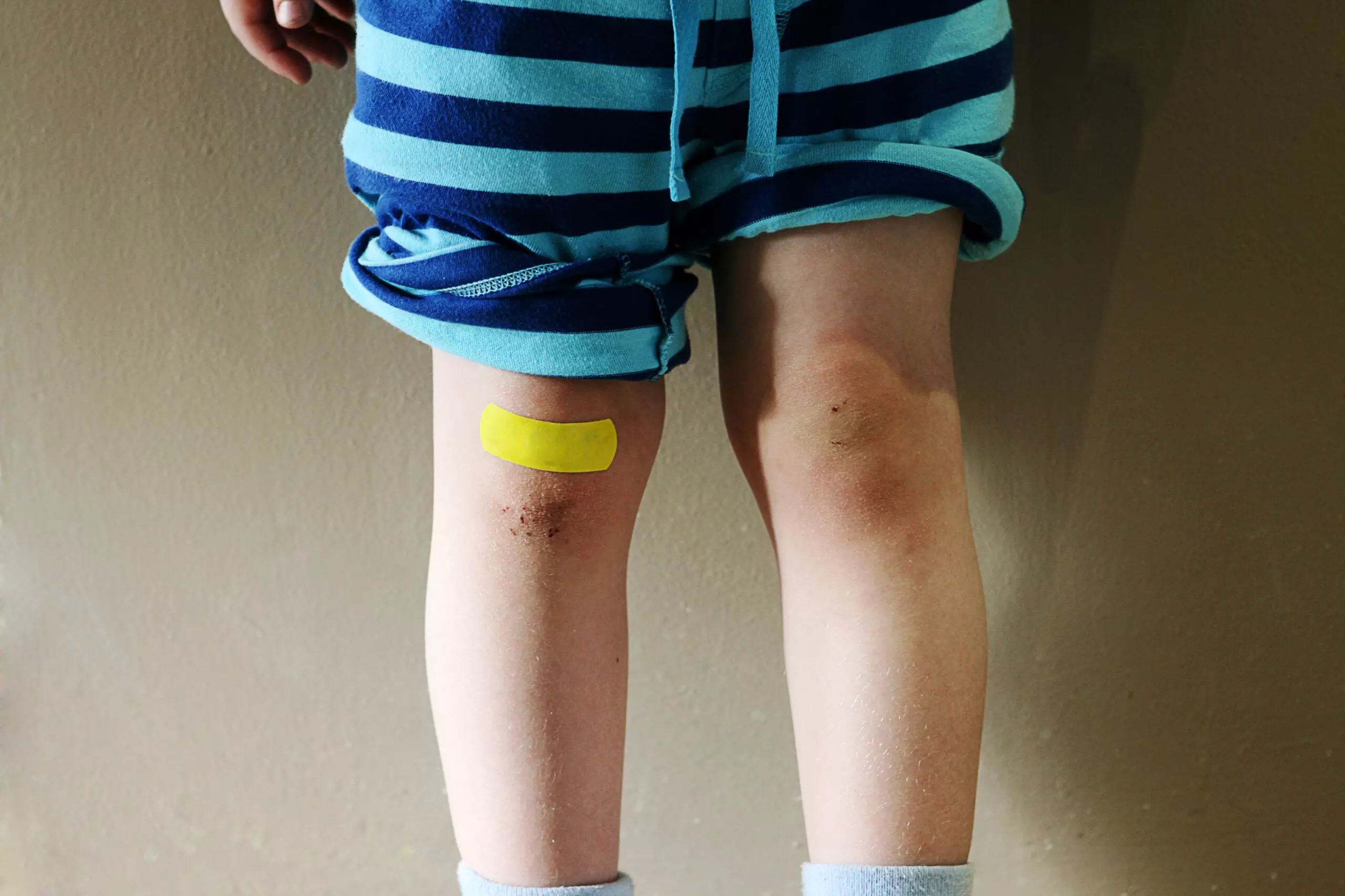 Колени ребенка с порезами, синяками и лейкопластырем.