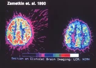 Clinical brain imaging scan ye adhd